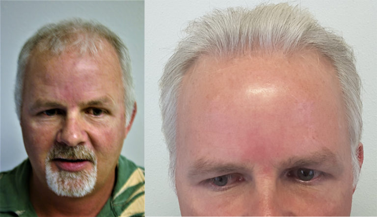 FUT Patient Before & After Photos | Limmer HTC