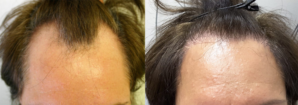 Female Hair Loss Patient Limmer Htc San Antonio Tx