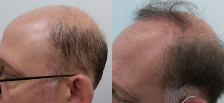 Norwood 6 Hair Transplant Results and Medicinal Therapy Options
