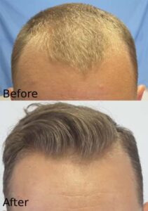 Hair Growth Treatments - Limmer HTC, San Antonio TX